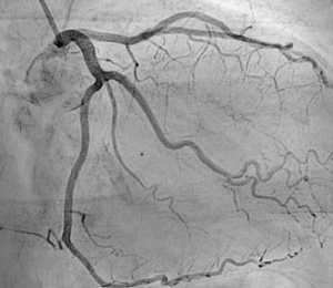 Coronary Angiography : Best CAG in Agra : Best Interventional ...